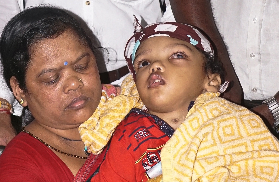 Kalia One Of The Conjoined Twins Separated In Complex Surgeries Dies